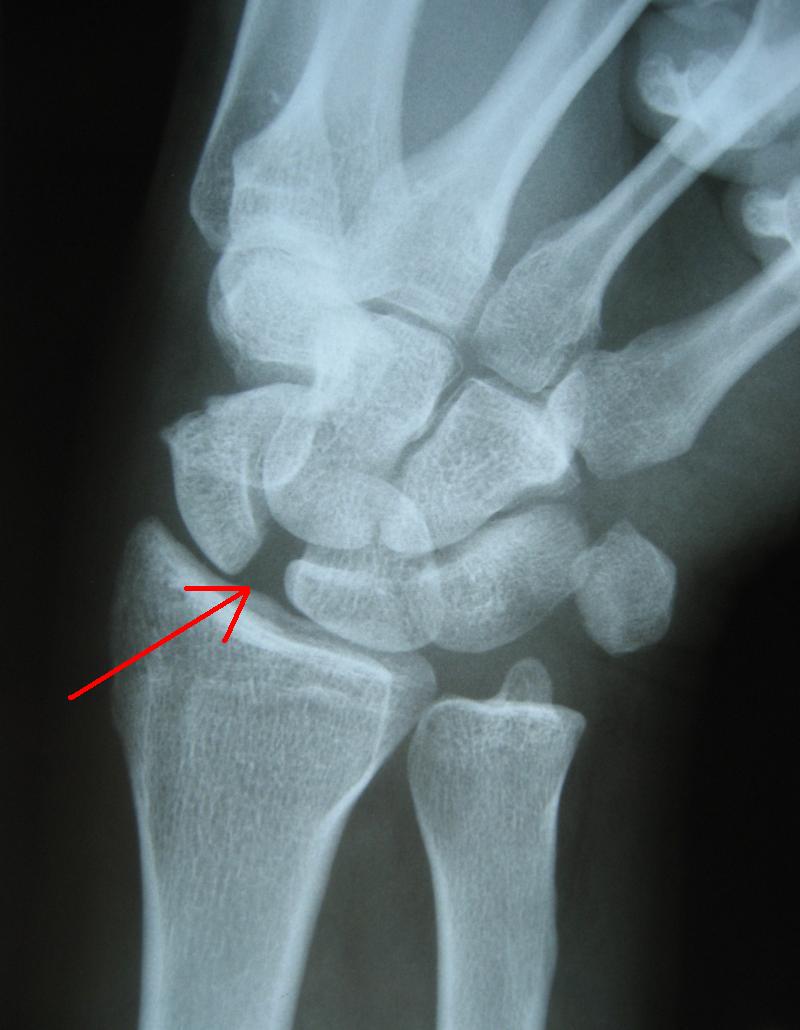 Scapholunate Dislocation Scapholunate Dislocation