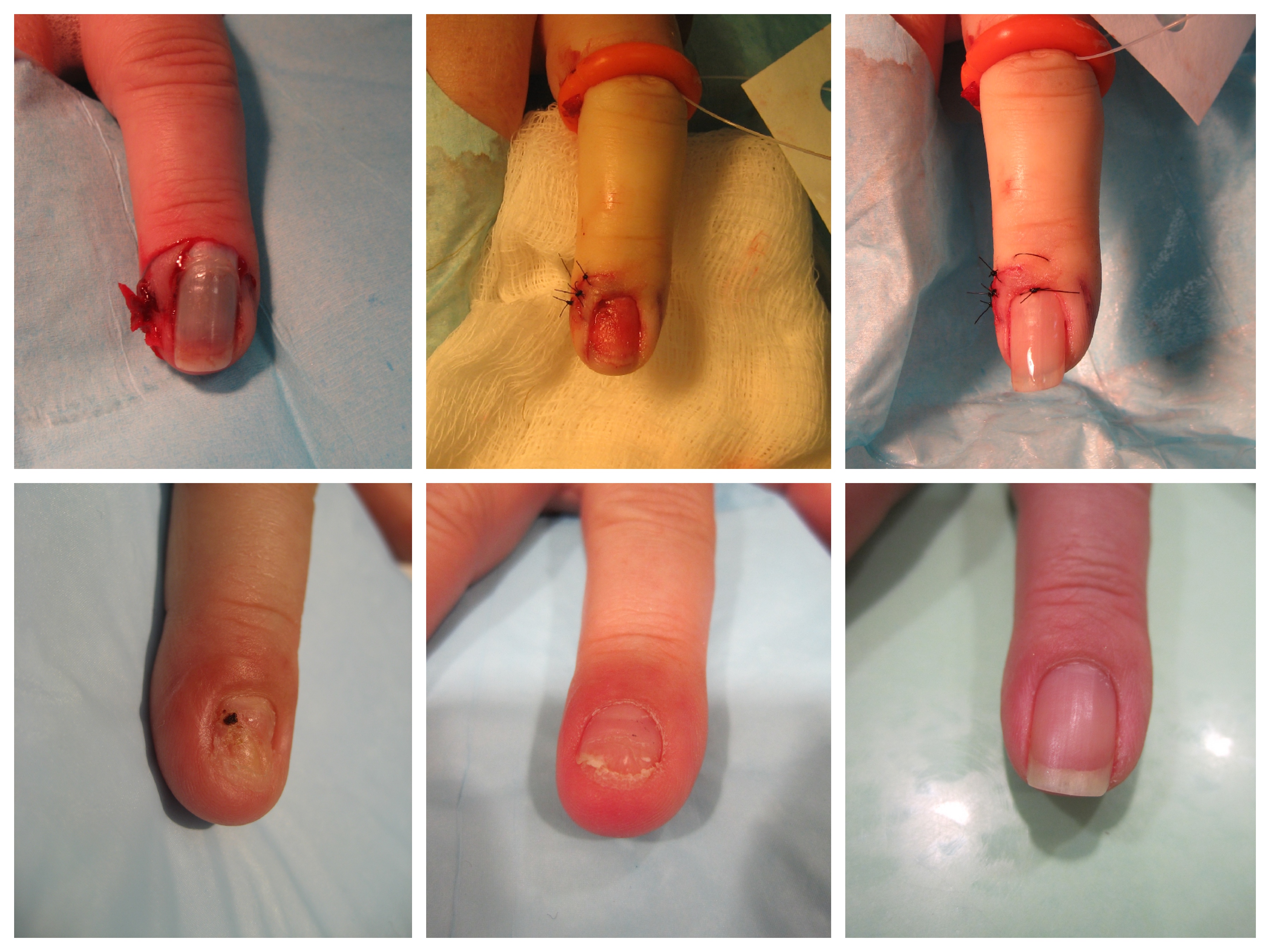 Surgical Repair Of Fingernail Injury John Erickson MD