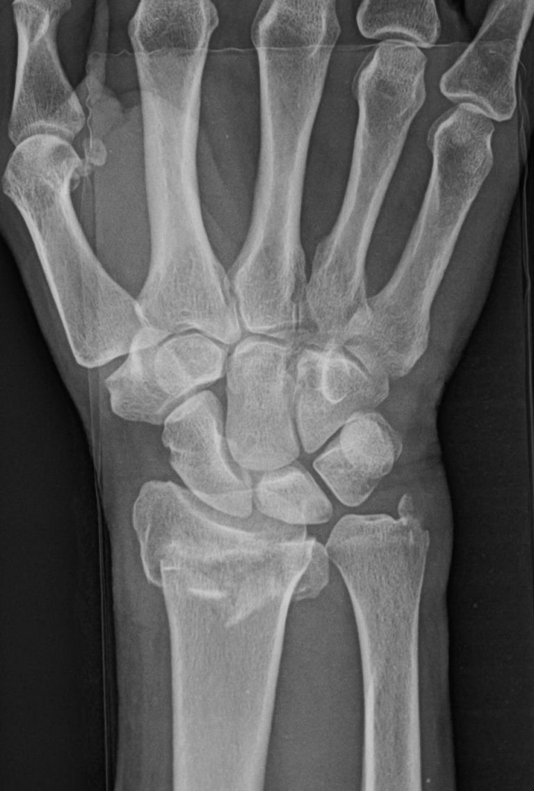 broken wrist raleigh hand doctor