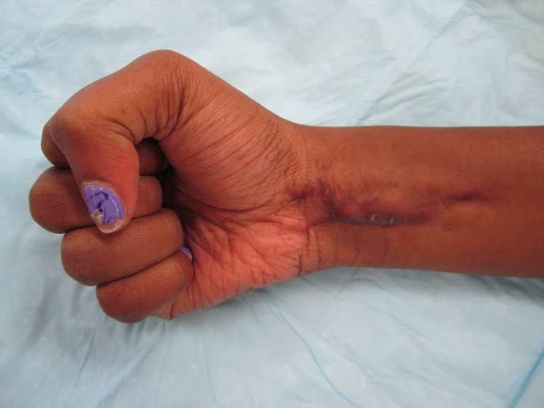 Median Nerve and Tendon Repair Case - John Erickson, MD