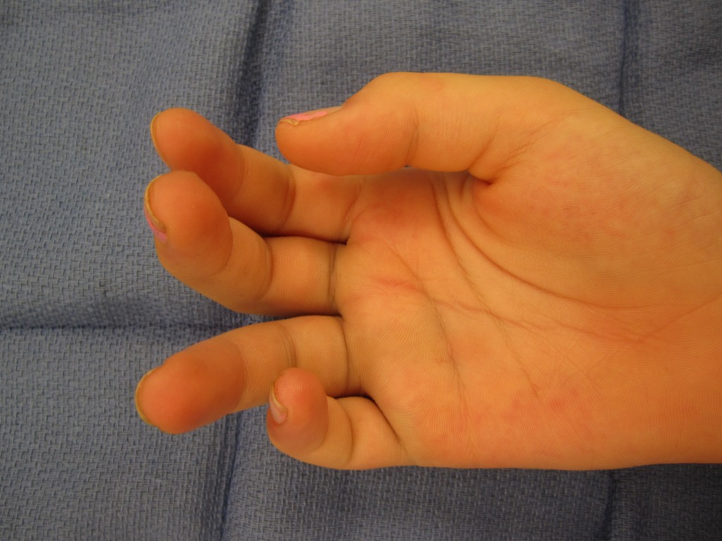 Less-Invasive Finger Fracture Treatment - John Erickson, MD
