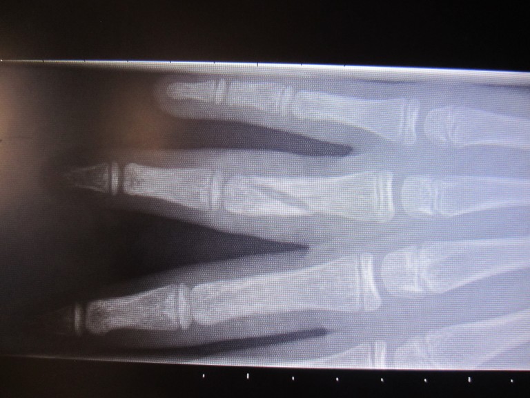 Less-Invasive Finger Fracture Treatment - John Erickson, MD