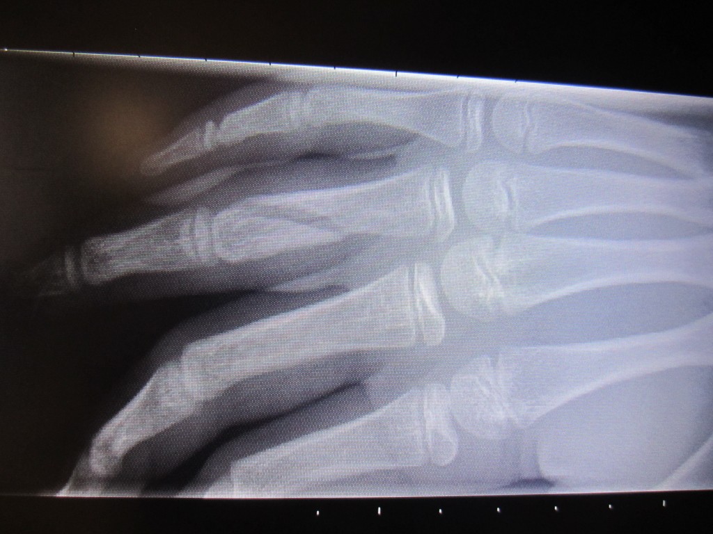 Less-Invasive Finger Fracture Treatment - John Erickson, MD