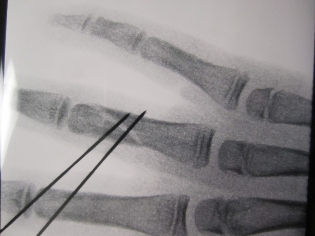Less-Invasive Finger Fracture Treatment - John Erickson, MD