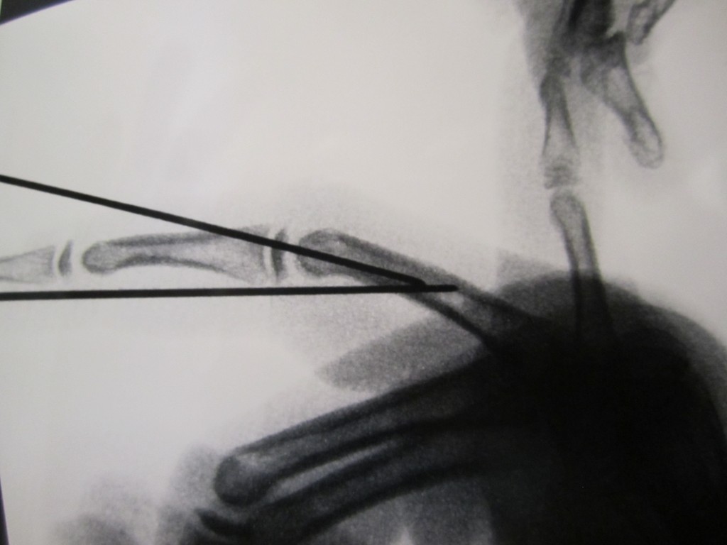 Less-Invasive Finger Fracture Treatment - John Erickson, MD