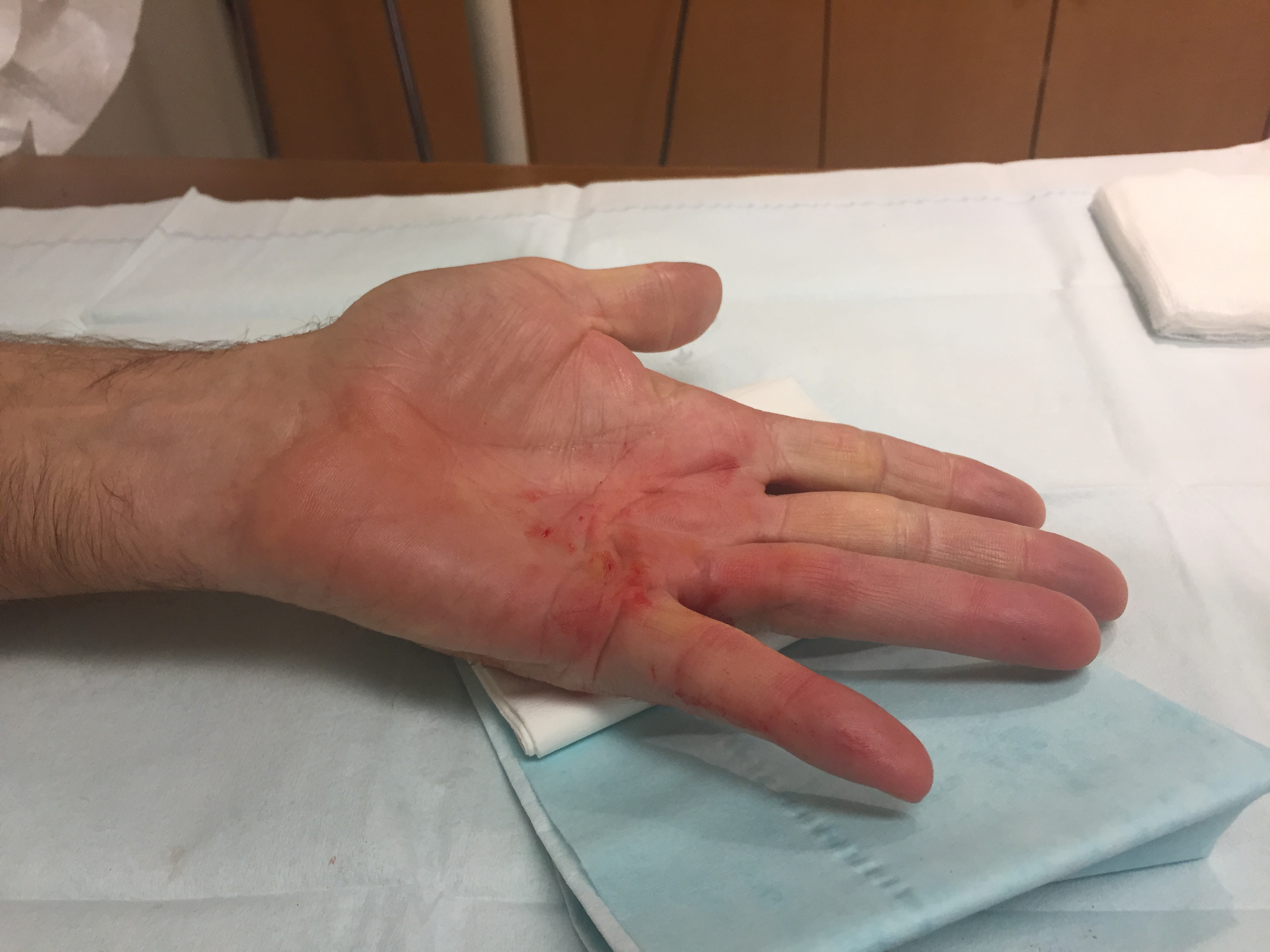 Dupuytrens2 - John Erickson, MD