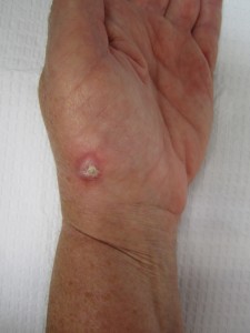 Hand Tumors - John Erickson, MD