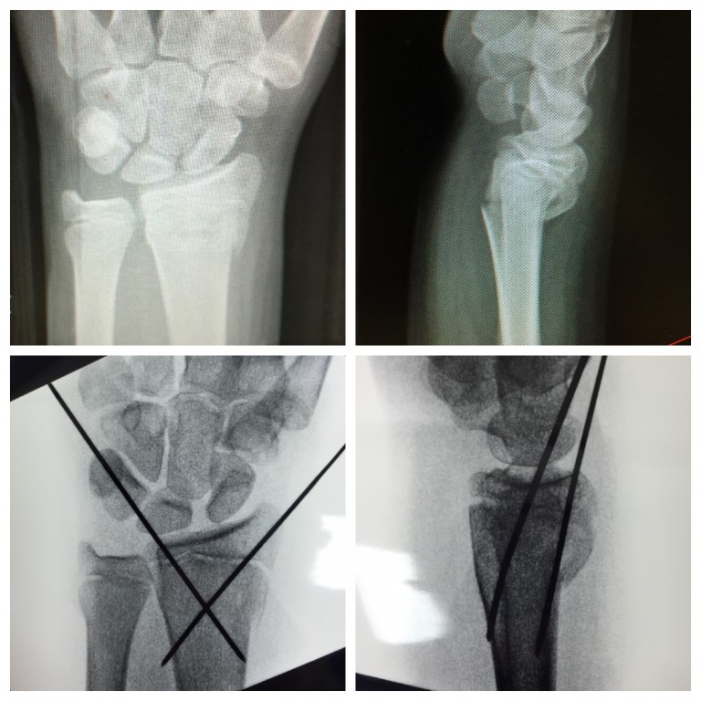 Distal Radius CRPP - John Erickson, MD