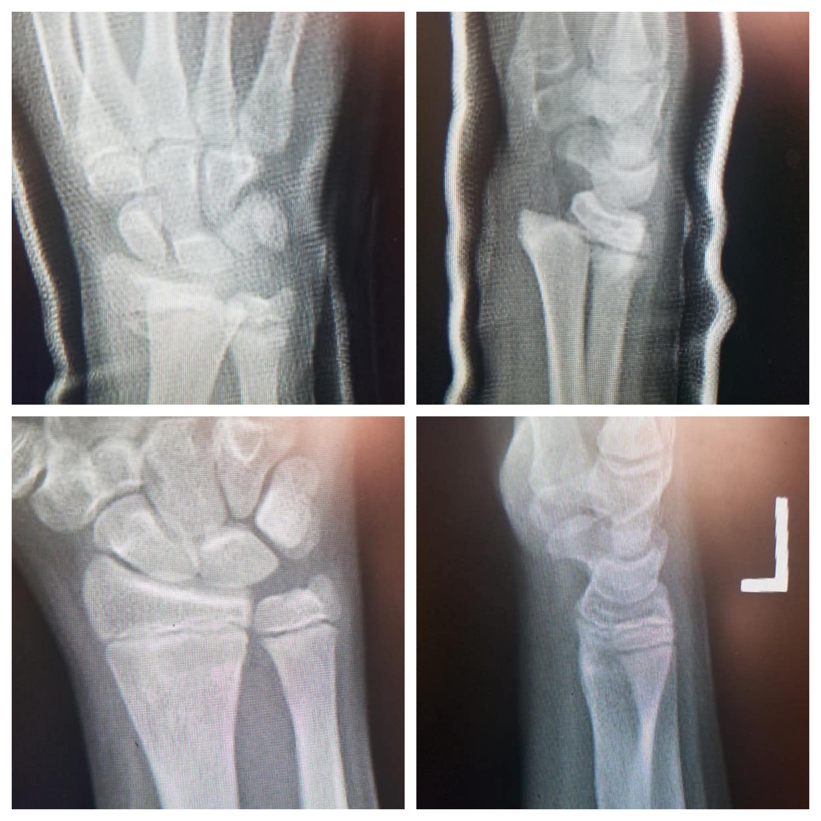 Distal Radius Distal Radius Fracture (Broken Wrist) In Singapore