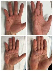 vikings disease dupuytens contracture