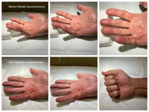 vikings disease dupuytens contracture
