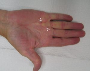 lump palm of hand