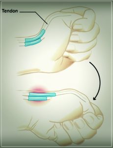 thumb wrist tendonitis self help