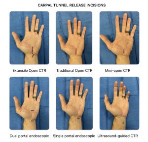 best carpal tunnel release surgery