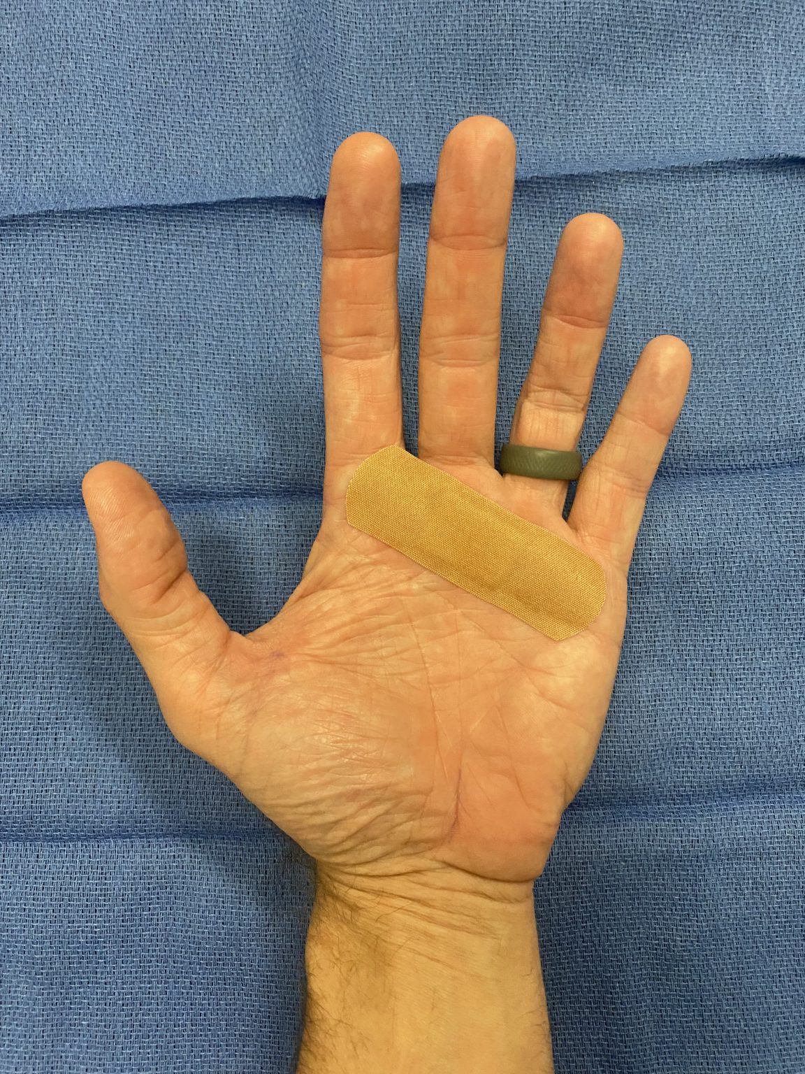 What is a Trigger Finger? Dr. Erickson explains