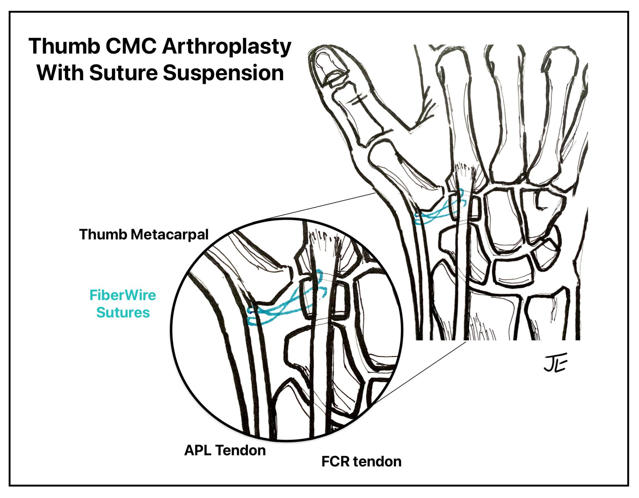 Thumb Arthritis Treatment in Raleigh by Dr. Erickson