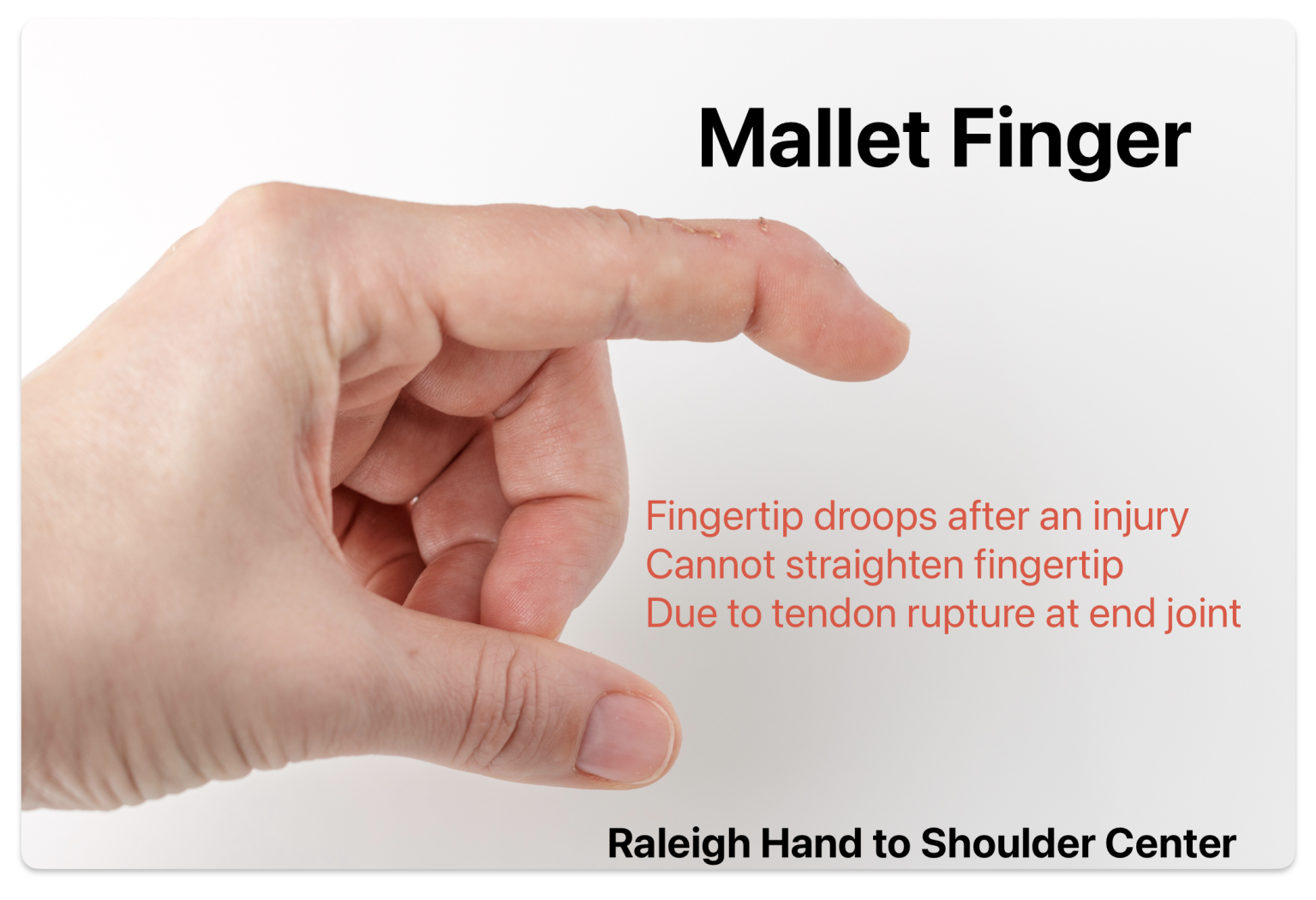 Mallet Finger - John Erickson, MD