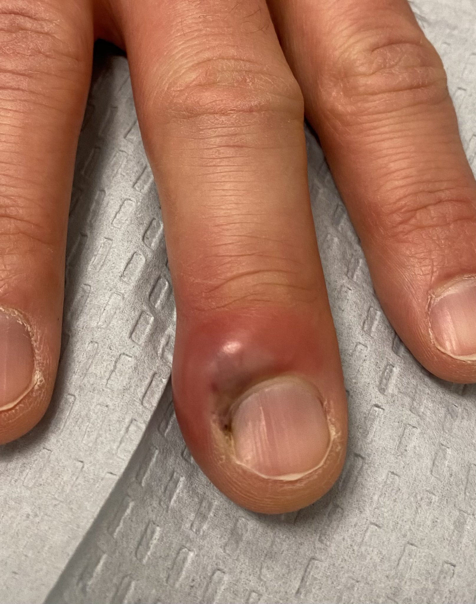What is a paronychia fingernail infection? - John Erickson, MD